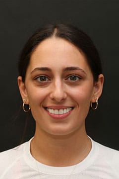 Before & After Myofunctional Therapy in Woburn, MA | Haley Testimonial