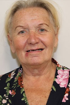 Mary Jane New You Dentures Before & After | Woburn, MA